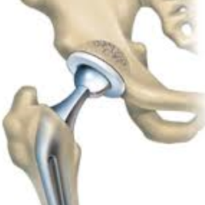 Hip Replacement – Infection | Gorav Datta