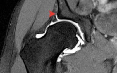 Labral Tears | Gorav Datta