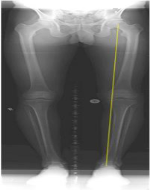 High Tibial Osteotomy (HTO) and Biological Knee Replacements | Gorav Datta